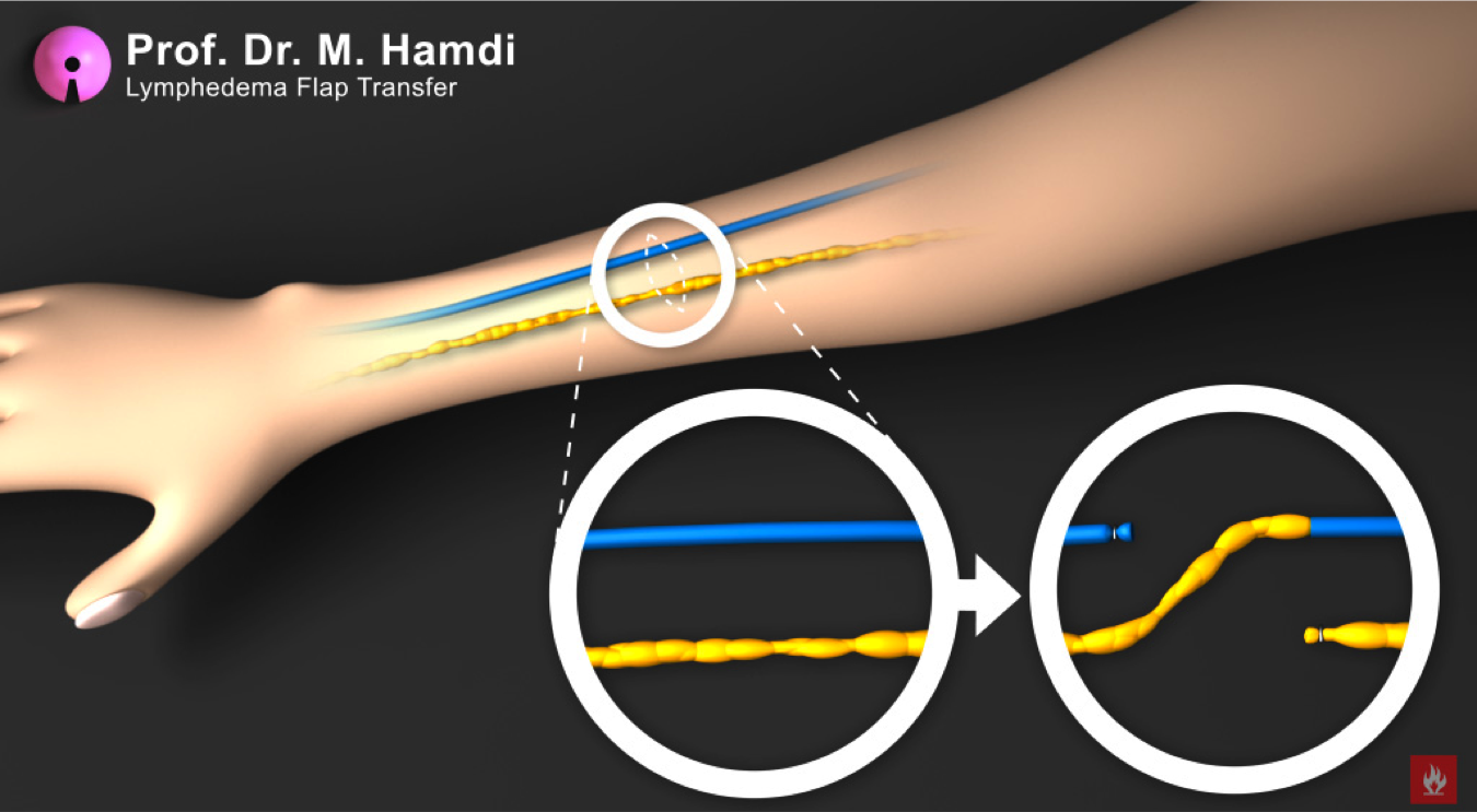 Lympho - Venous Anastomosis (LVA) in "supermicrosurgery technique ...