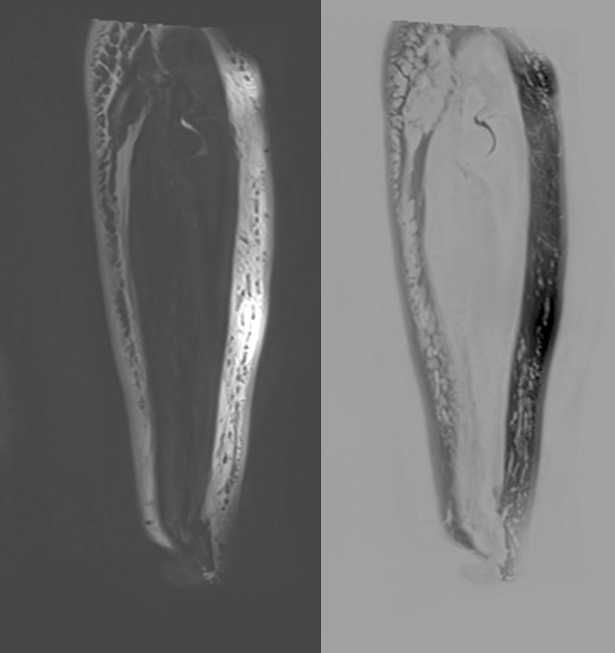 MR - Lymphography - European Center for Lymphatic Surgery